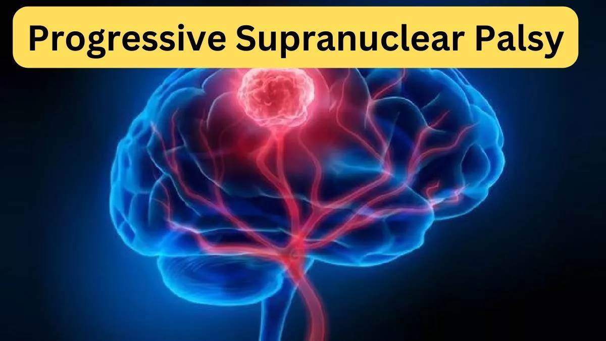 Progressive Supranuclear Palsy: ਜਾਣੋ ਕੀ ਹੈ ਇਹ ਦੁਰਲੱਭ ਬਿਮਾਰੀ, 1 ਲੱਖ 'ਚੋਂ ...
