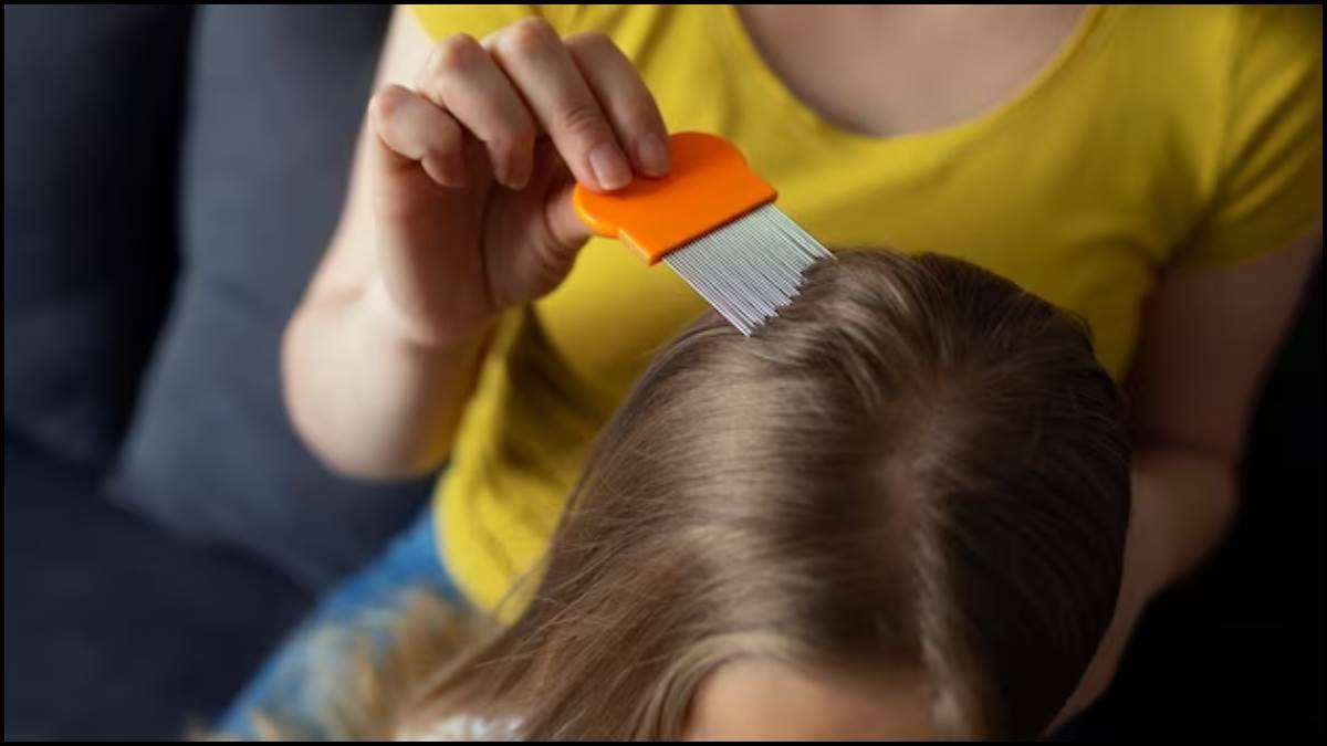 Lice Home Remedies ਗਰਮੀਆਂ ਚ ਕਿਉਂ ਵਧ ਜਾਂਦੀ ਹੈ ਜੂੰਆਂ ਦੀ ਸਮੱਸਿਆ ਜਾਣੋ