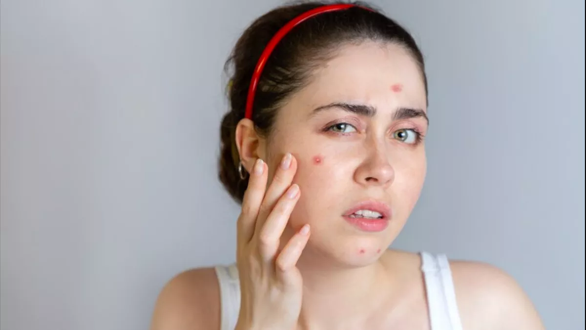 Pimple Home Remedies ਪਿੰਪਲਜ਼ ਤਾਂ ਦੂਰ ਹੋ ਜਾਂਦੇ ਹਨ ਪਰ ਦਾਗ ਰਹਿ ਜਾਂਦੇ ਹਨ